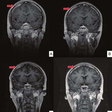 Pdf Recurrent Spinal Primitive Neuroectodermal Tumor With Brain And