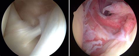 Frozen Shoulder Adhesive Capsulitis Orthoinfo Aaos