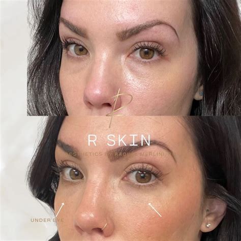 The Gallery Before And After Beauty Services R Skin