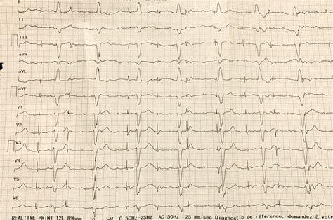 Electrocardiogram On Admission Showing Complete Heart Block With Download Scientific Diagram