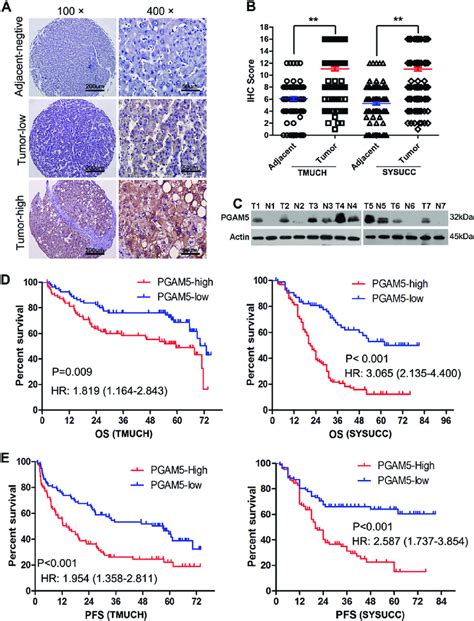 Pgam5 Expression In Hcc Tissues And Its Prognostic Significance In