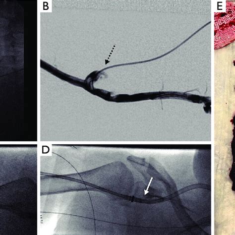 Aspiration Thrombectomy Of Clotted Hero Graft Using The Indigo System Download Scientific