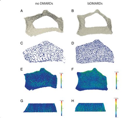 Hr Pqct And Finite Element Analysis Left Psoriatic Arthritis Psa Download Scientific