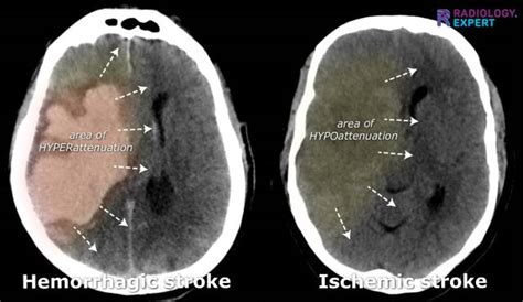 Interventional Radiology The Stroke Patient