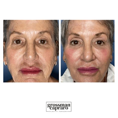 Renuva Grossman Capraro Plastic Surgery