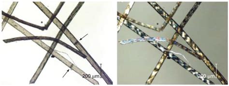 Trichothiodystrophy A Systematic Review Of 112 Published Cases
