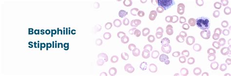 Basophilic Stippling Causes Diagnosis And Treatment