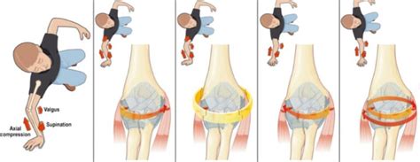 Complex Elbow Dislocations Terrible Triad Injuries Hand And Nerve