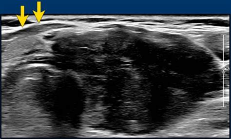 The Radiology Assistant Ti Rads Thyroid Imaging Reporting And Data System