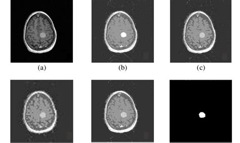 Stages Of Tumor Extraction A The Original Tumor Image B The