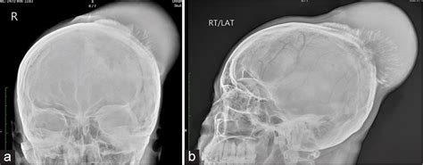 Sun Ray Periosteal Reaction In The Calvarium Uncommon Presentation Of A Common Disease