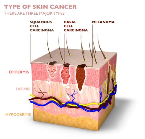 Types Of Skin Cancer Skin Cancer Types Basal Cell Carcinoma Overview