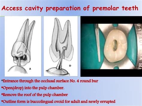 Acces Opening Of Anterior And Premolar Teethshadan