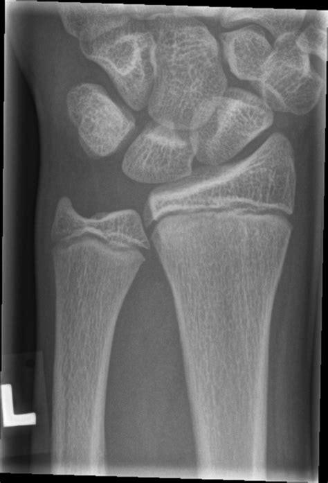 Wrist Junk Object Detection Dataset V3 Wrist Fx V3 0 By Bonez