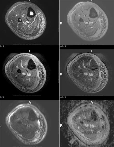 Notice Staph Micro Abscesses Only Seen On Adc Ocad