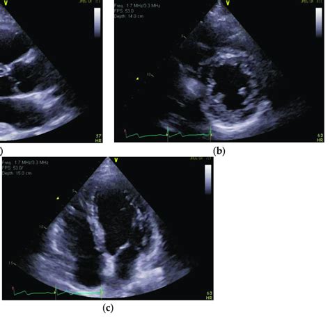 Transthoracic Echocardiography Transthoracic Echocardiography Showed Download Scientific