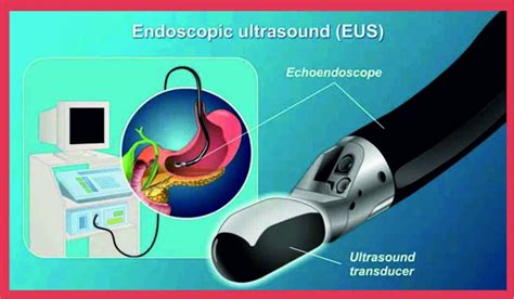Understanding Endoscopic Ultrasoundeus Sai Institute Of