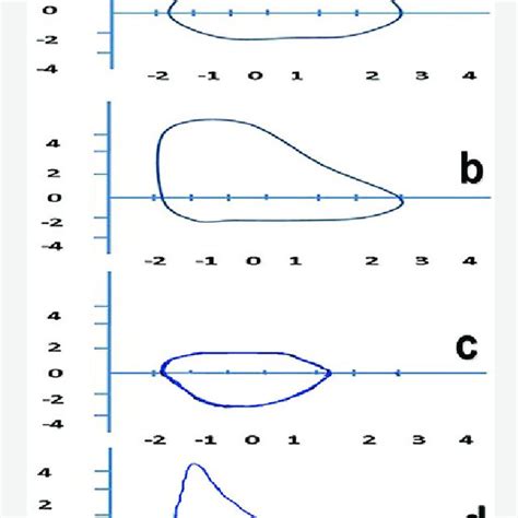 Types Des Obstructions Bronchiques Extrathoraciques A Fixe B