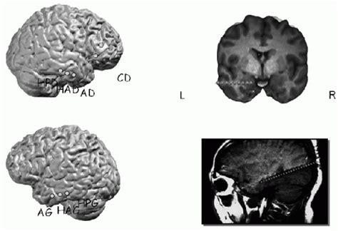 Intracranial Monitoring Depth Subdural And Foramen Ovale Electrodes Neupsy Key
