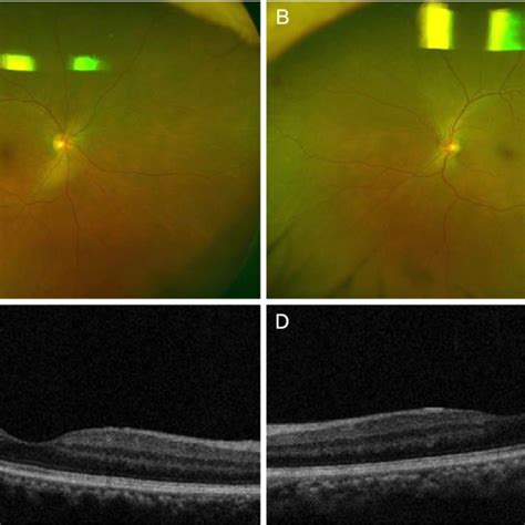 Seven Days After The Initial Visit Choroiditis And Choroidal Download Scientific Diagram