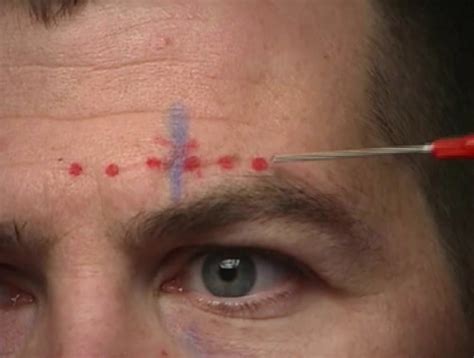Supratrochlear Nerve Block