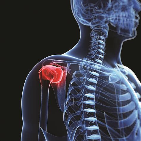 Preventing Rotator Cuff Injuries With Corrective Exercise Part 1