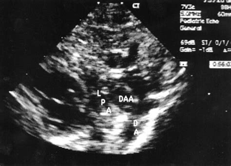 Suprasternal Long Axis View Of Echocardiography Showing A Large Daa