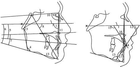 angular measurements of hard tissue 1 facial angle 2 angle of