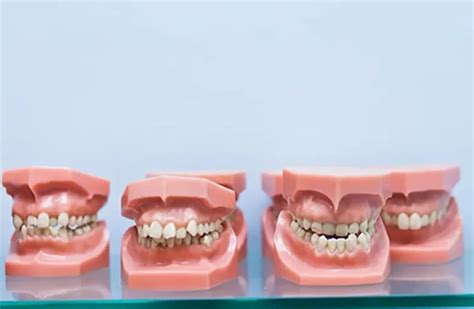 Malocclusion Classes Causes And Treatment Smile Plus