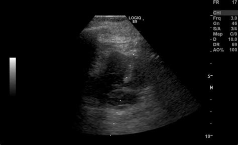 Radiopaedia Case Sarcomatoid Renal Cell Carcinoma Id 32919 Study