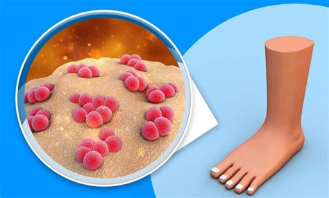 Ulcer Wound Stephi LaReine