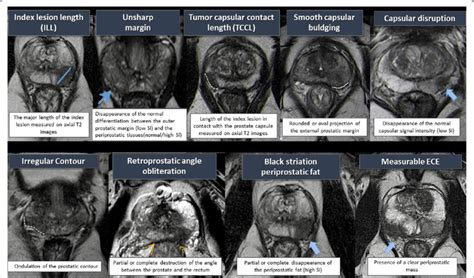 Mri Semantic Features For Detection Of Pece Download Scientific Diagram