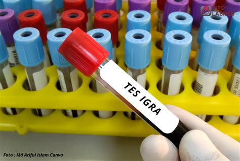 Mengenal Interferon Gamma Release Assay Igra Tes Darah Untuk