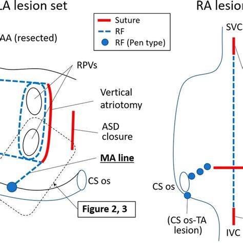 Lesion Sets Of The Prior Maze Procedure Red Lines Indicate Cut And Download Scientific Diagram
