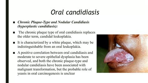 Red And White Lesions Of The Oral Mucosapptx