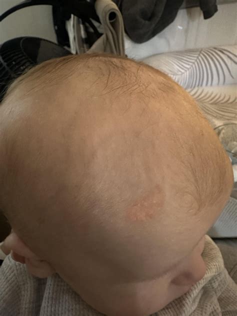 Newborn Scalp Lesion R Dermatologyquestions