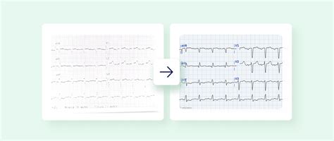 How To Improve The Quality Of An Ecg Instantly With Examples