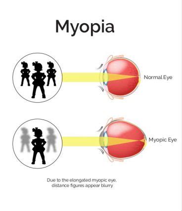 Why You Should Care About Myopia Eyeworks Myopia Management Center