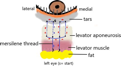 Schematic Diagram Of Surgical Procedure Download Scientific Diagram