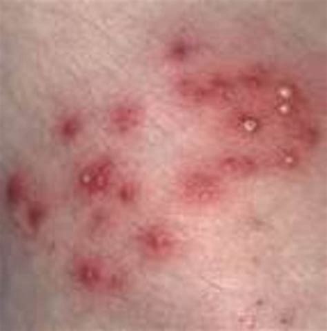 Early Mrsa