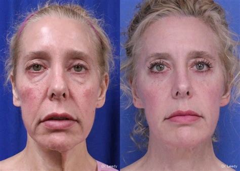 Before And After Cleveland Plastic Surgery Institute