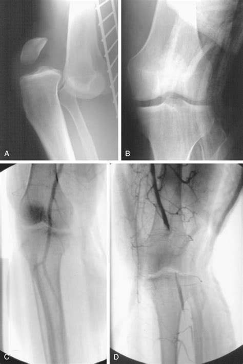 Classification Of Knee Dislocations Clinical Tree