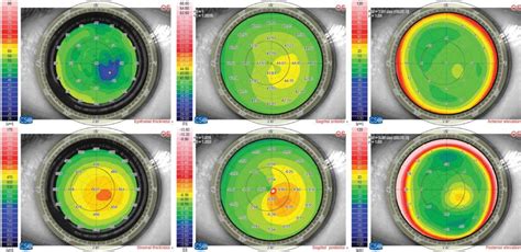 Epithelial Thickness Mapping For Keratoconus Screening By Vhf Digital