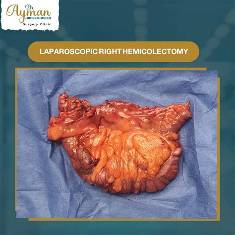 Laparoscopic Right Hemicolectomy Dr Ayman Abd Elha