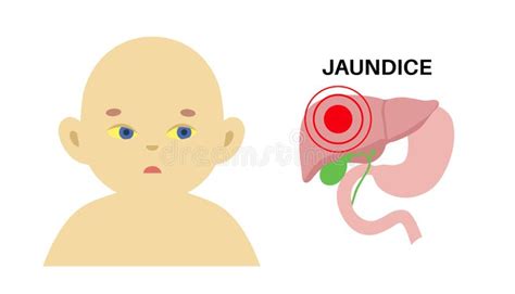 Jaundice Yellow Skin Stock Illustration Illustration Of Newborn 375484273