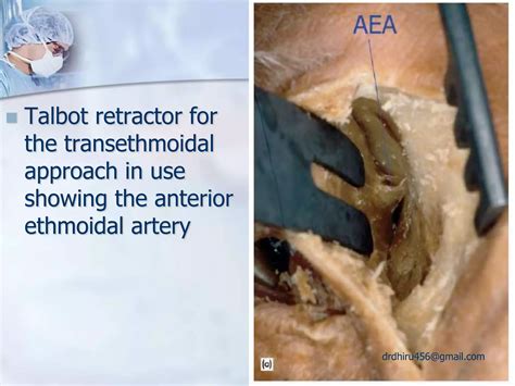 Transsphenoidal Hypophysectomy By Drdhiru456 Pptx