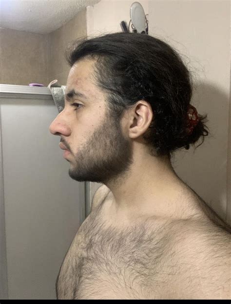 18 20yo 1y And 10 Months Difference Mewing Mouth Taping And Posture Im Bulking So My Body