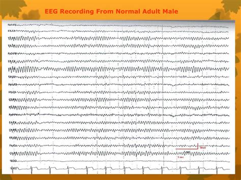 Ppt Electroencephalography And Event Related Potentials Eeg And Erp