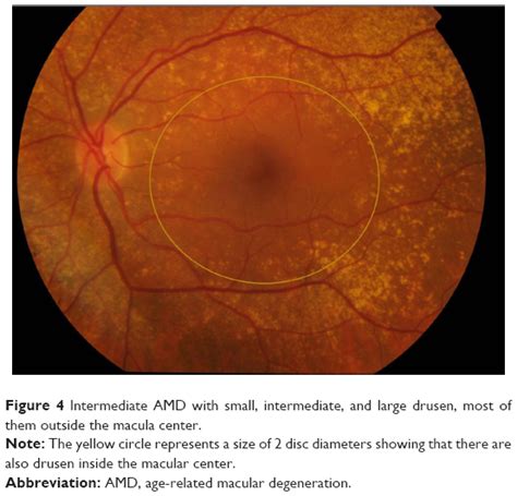 Early And Intermediate Age Related Macular Degeneration Update And Cl