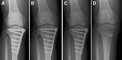 What Is A Hinge Fracture At Tracy Mcfall Blog